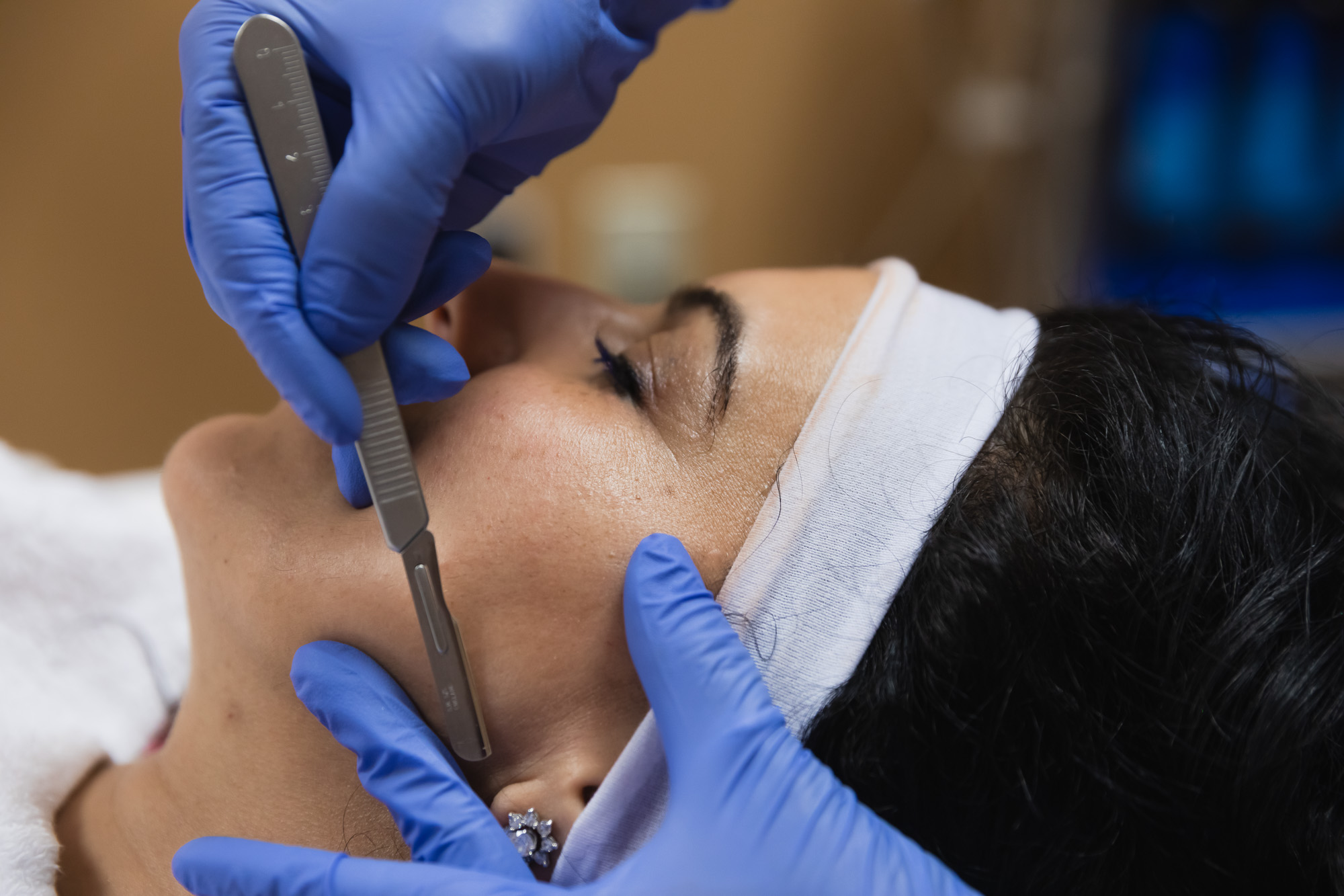 Dermaplaning in Silverdale | Kate Allen Aesthetics