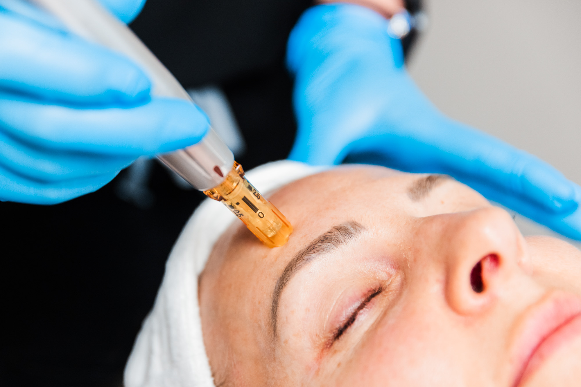 Dermal Needling in Silverdale | Kate Allen Aesthetics