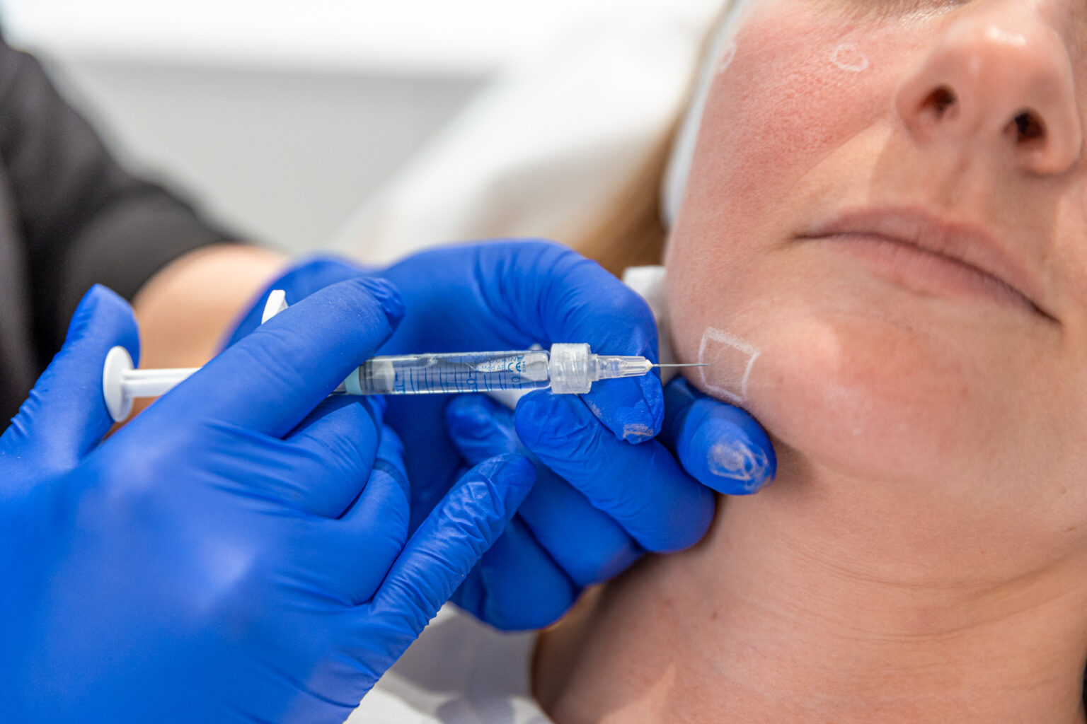 Dermal Fillers in Silverdale| Kate Allen Aesthetics